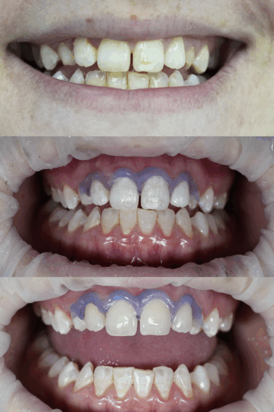 Icon Treatment | MJ Warren Dental Practice